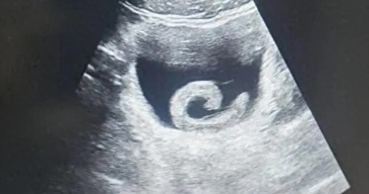 Người đàn ông phải nhập viện cấp cứu vì… đỉa sống trong bàng quang